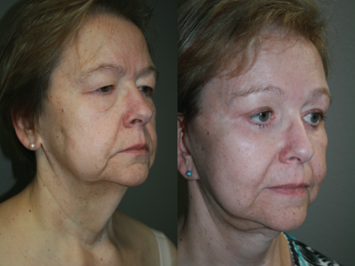 Face Lift: Patient C | Leonard Plastic Surgery - Salem, Oregon